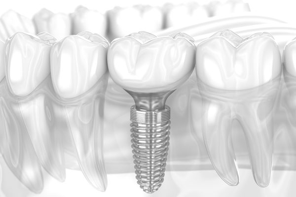 7 Signs You Might Need Dental Implants Sooner Than You Think - Lee ...